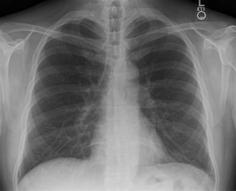 Normal Cxr Geeky Medics