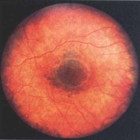 Fundus Photograph Of The Left Eye Showing Pigmentary Maculopathy
