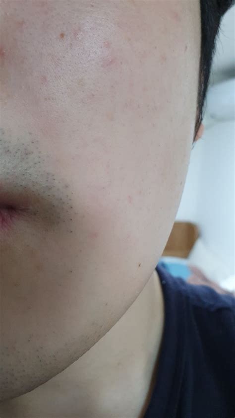 모세혈관확장증주사염인가요 진단 및 치료비용 문의 내공100 지식in