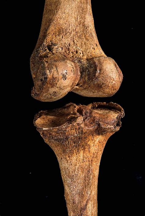 Is Knee Osteoarthritis A Mismatch Disease Harvard Magazine