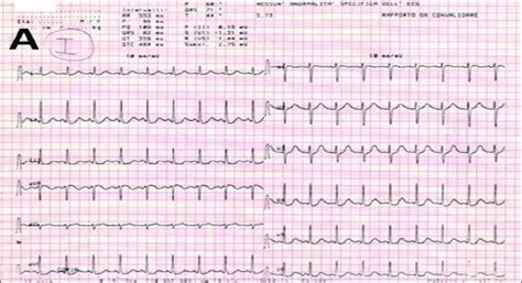 Electrocardiogram Was Suggestive Of Subendocardial Ischemia In