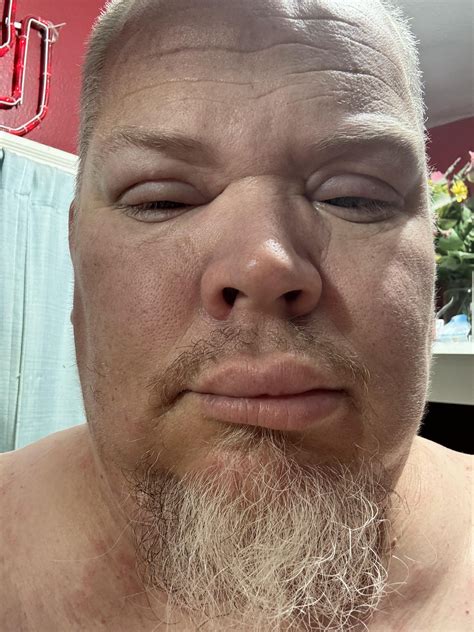 Face Swelling And Hives Dailey Still Trying To Figure Out Whats Causing