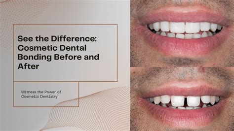 See The Difference Cosmetic Dental Bonding Before And After Photos