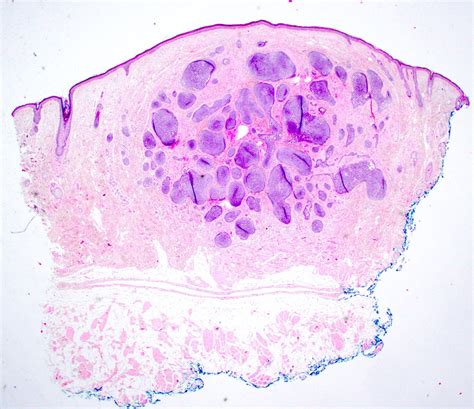 Pathology Outlines Trichoepithelioma Trichoblastoma