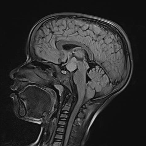 Hypothalamic Hamartoma Pacs