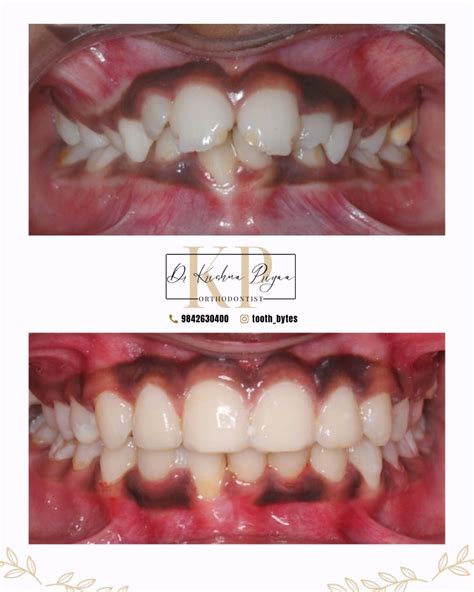 Dr Krishna Priyaa On Linkedin Severe Constriction Of Maxilla And