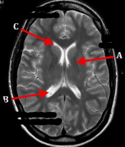 Brain Mri Flashcards Quizlet
