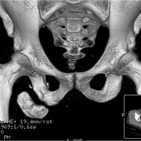 Three Dimensional Reconstruction Computed Tomography Scan Showing A