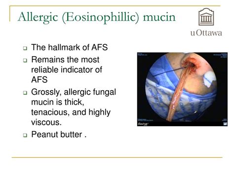 Ppt Fungal Rhinosinusitis Powerpoint Presentation Free Download Id