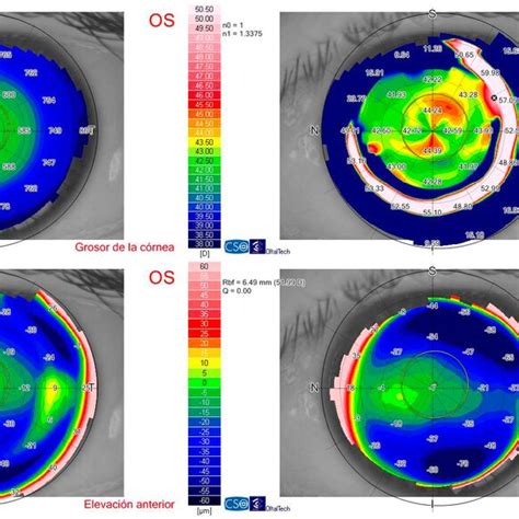 Multifocal Epithelial Hyperplasia A Multiple Pedunculated Soft
