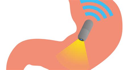 Capsule Endoscopy For Crohns Disease Ibdrelief