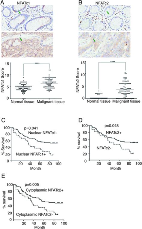 Tumor Expression Of Nfatc2 And Nuclear Nfatc1 Correlated With