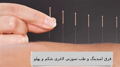فرق امبدینگ و طب سوزنی را بدانید