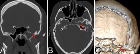 Endoscopic Endonasal Repair Of Temporal Lobe Meningoencephalocele In