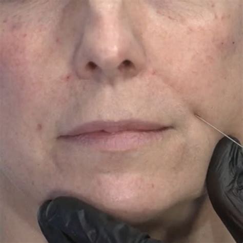 The Best Botox Injection Depths Dr Tim Pearce