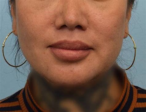 Before And After Renuvion Skin Tightening Procedures In Houston Tx Face