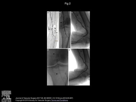 Endovascular Treatment Of Atherosclerotic Popliteal Artery Disease