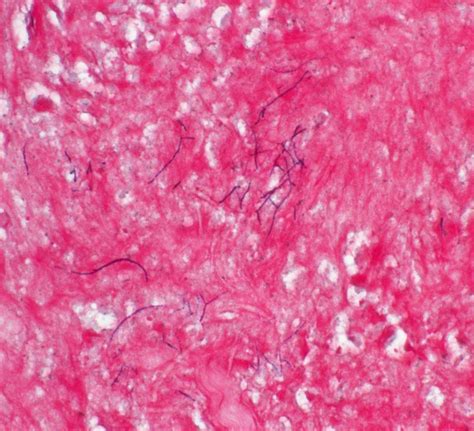 Jerad Gardner Md On Twitter Rt Jmgardnermd Nocardia Infection Causing Cellulitis And Eschar