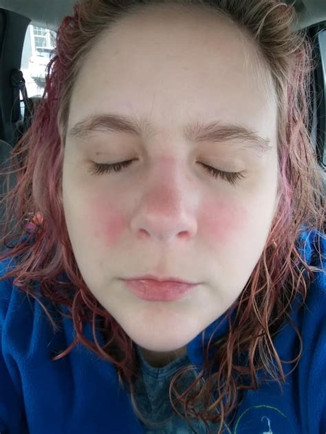 Is This A Butterfly Rash I Have Mctd But This Is New Rlupus