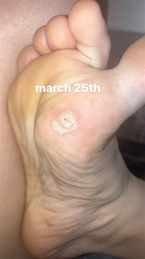 Plantar Wart Progression Rwarts