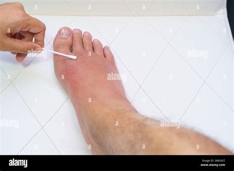 Gros Plan Sur Le Pied Droit De Lhomme Cheville Blessé En Attente Et
