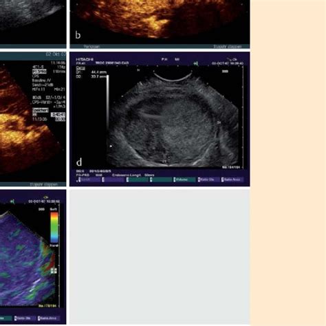 Typical Appearance Of A Large Gist Of The Stomach Detected By