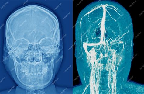 뇌혈관의 Mri 및 뇌혈관 질환 또는 출혈성 뇌졸중 뇌졸증 Xray 이미지 프리미엄 사진
