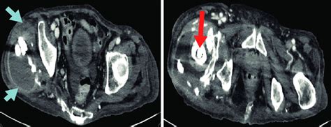 Computer Tomography Scan Of Abscess Formation Around The Right Hip Download Scientific Diagram