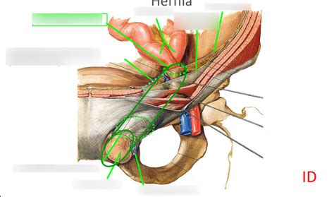 Direct Vs Indirect Inguinal Hernia Diagram Quizlet