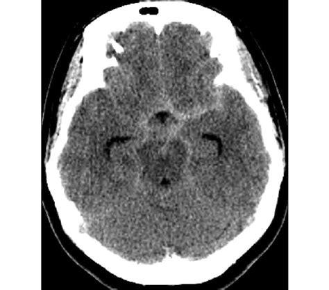 Preoperative Computed Tomography Images Show Diffuse Subarachnoid Download Scientific Diagram