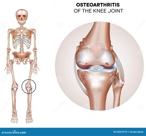 Arthritis Of The Knee Joint Stock Vector Illustration Of Diagnose