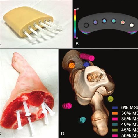 Pdf Iterative Reconstruction May Improve Diagnosis Of Gout An Ex