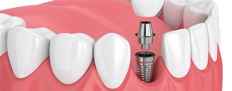 Weighing Up The Pros And Cons Of Dental Implants
