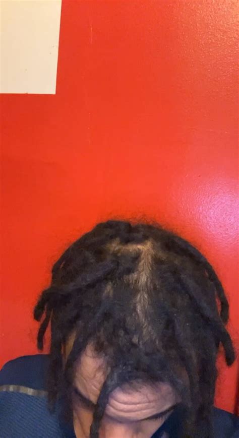 Am I Balding R Dreadlocks