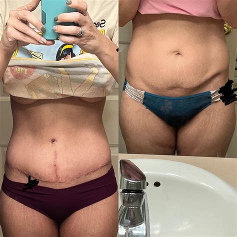 6 Weeks Post Op Rtummytucksurgery