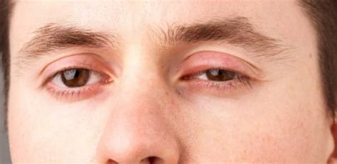 ألوان الوطن ما أسباب تورم العين عند الاستيقاظ من النوم؟ 3 نصائح