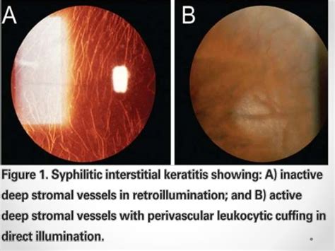 Interstitial Keratitis Interstitial Keratitis
