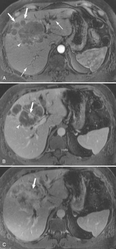 Investigative Imaging Of The Liver Clinical Tree
