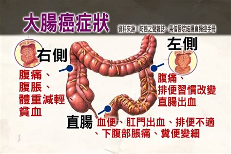 皮脂膜健康～解決你90的皮膚問題～cilia純天然保養品 大腸癌年輕化 3原則甩開癌化瘜肉