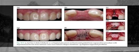 Ridge Augmentation Procedures