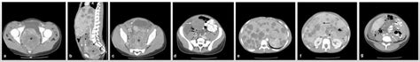 Axial Ct Scan Image Shows A Large Ill Defined Heterogeneous Solid