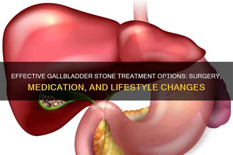 Effective Gallbladder Stone Treatment Options Surgery Medication And