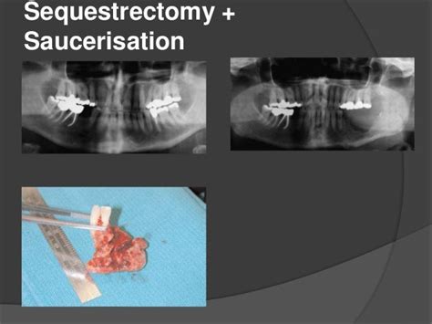 Osteomyelitis Of Jaws