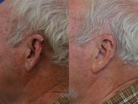 Mohs And Skin Cancer Surgery Before And After Pictures Case 5 Charlotte Nc Dilworth Facial