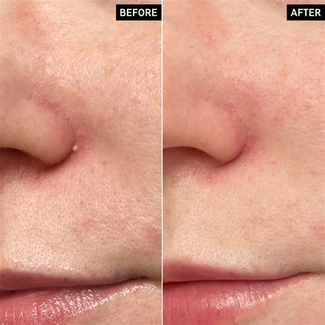 Hydrocolloid Invisible Patches Duo The Inkey List Ca