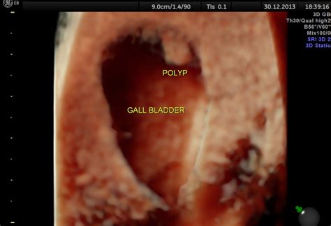 Gall Bladder Looking Through A Transducer Gall Bladder Looking Through A Transducer