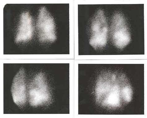 Perfusion Scintigraphy Of A 49 Year Old Man In Front Posterior Download Scientific Diagram