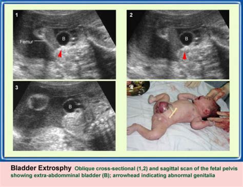 Bladder Exstrophy Department Of Obstetrics And Gynecology Faculty Of
