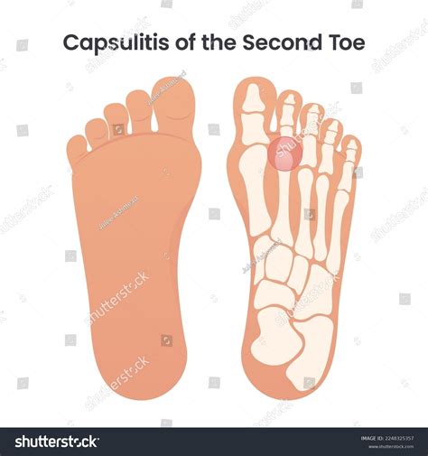 Capsulitis Second Toe Medical Vector Illustration Stock Vector Royalty