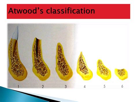 Residual Ridge Resorption Pptx